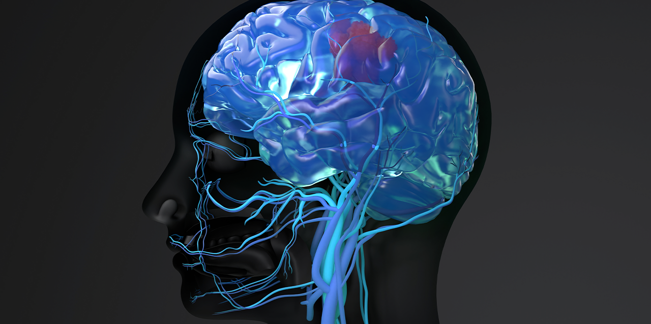 Extirpar un tumor cerebral con el paciente despierto, ¿es esto posible?